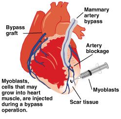 Rebuilding Damaged Heart Parts - Heart Advisor