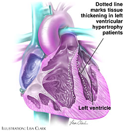 Relief for the Overworked Heart - Heart Advisor