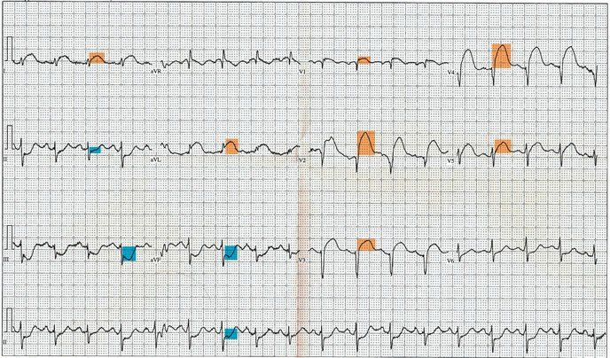 Balloon Pump May Help Patients With Cardiogenic Shock - Heart Advisor