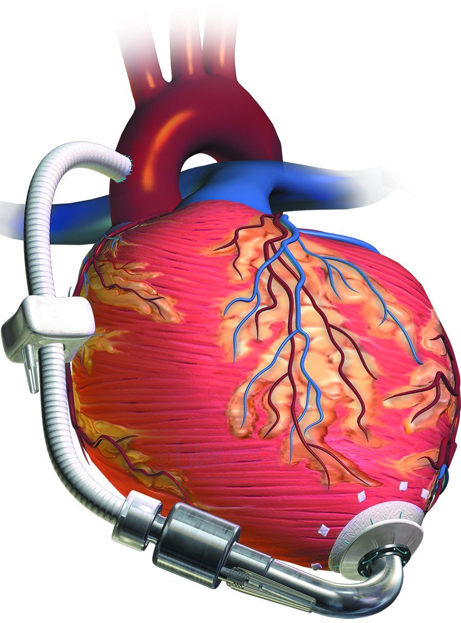 Earlier Pump Implantation Better for Heart Failure Patients - Heart Advisor