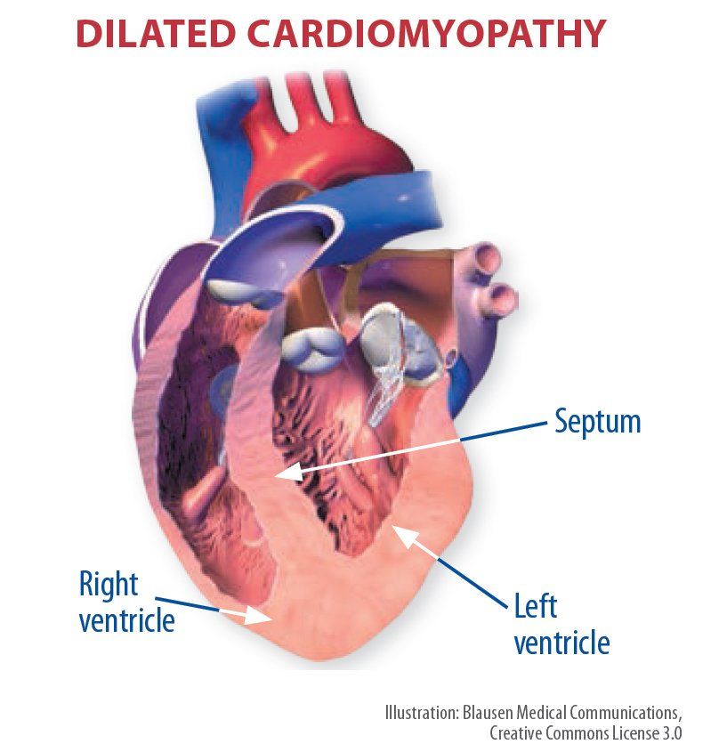 Understand the Different Types and Causes of Cardiomyopathy - Heart Advisor
