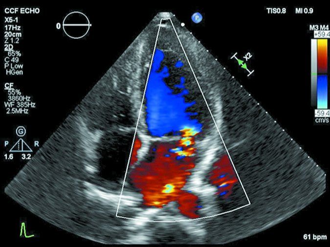 Echocardiography 101 - Heart Advisor