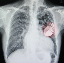 How Much Do You Know About Your “Ticker?” - Heart Advisor